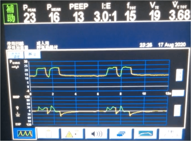 リバーストリガー（Reverse Triggering）を理解しよう | ICUと呼吸器外来のあいだ