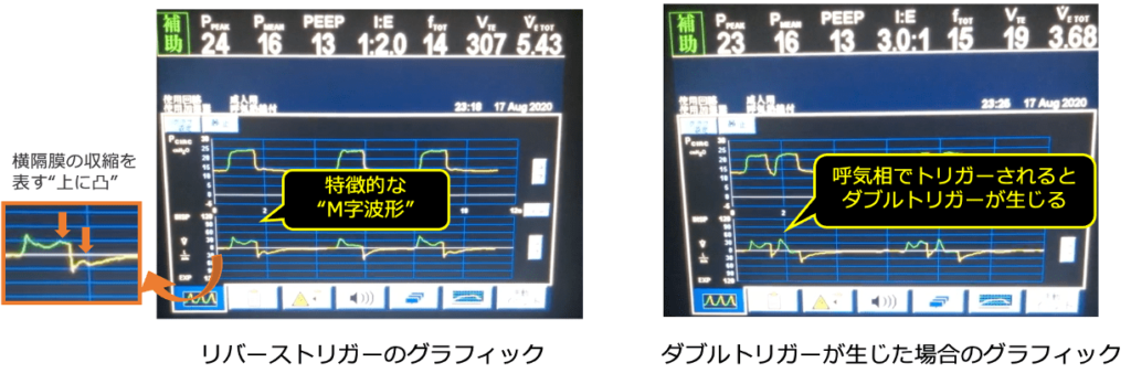 リバーストリガー（Reverse Triggering）を理解しよう | ICUと呼吸器外来のあいだ